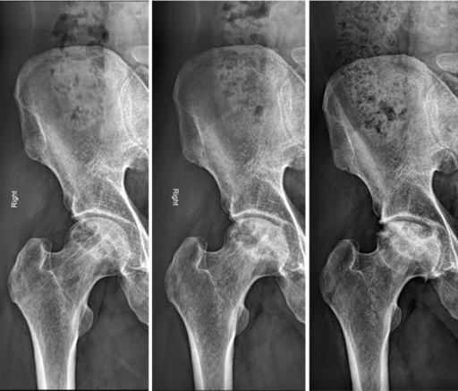 Osteonecrosis Of The Hip Xray Osteonecrosis Of The Hip Xray