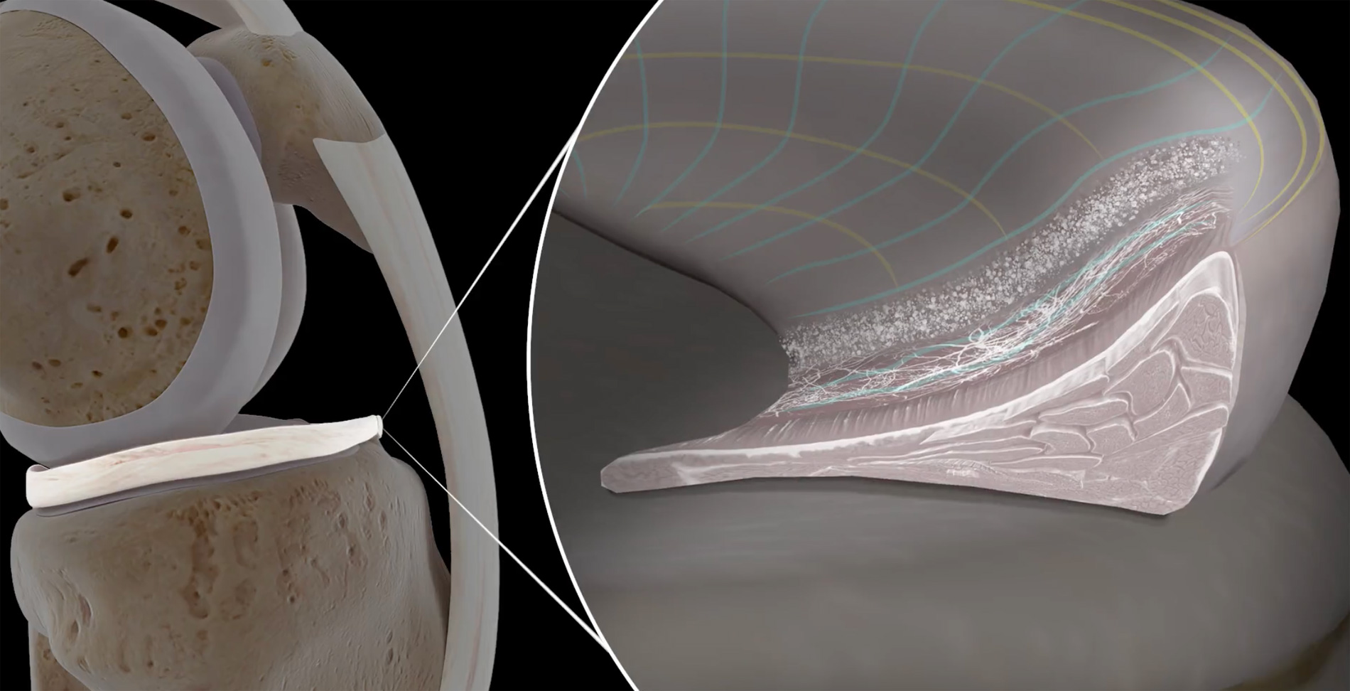Meniscal Tears & Injuries - Sam Martin