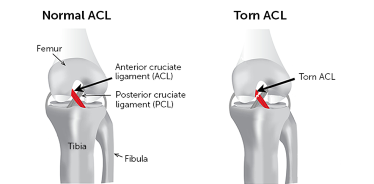 ACL Tears & Injuries - Sam Martin