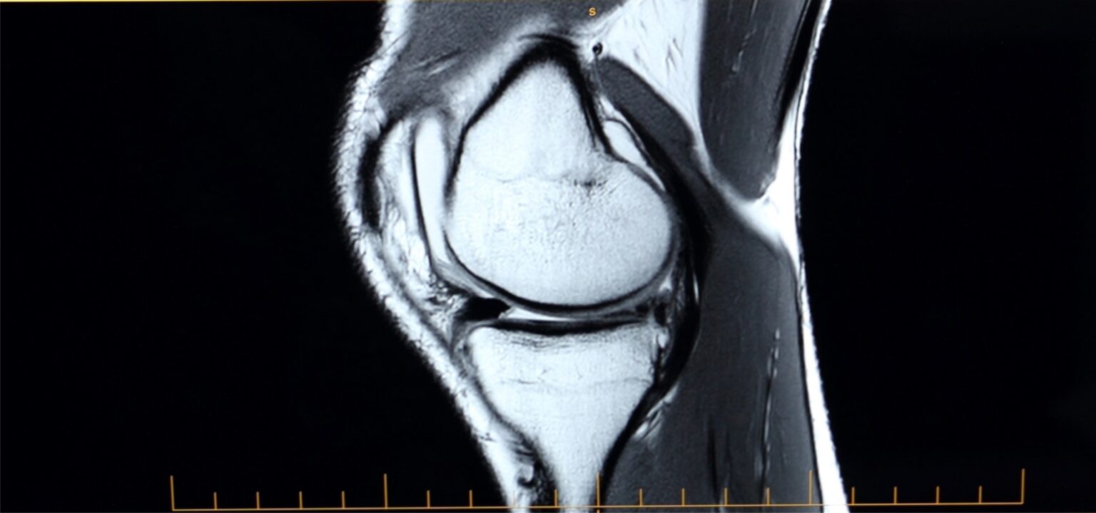 Knee Arthritis - Sam Martin