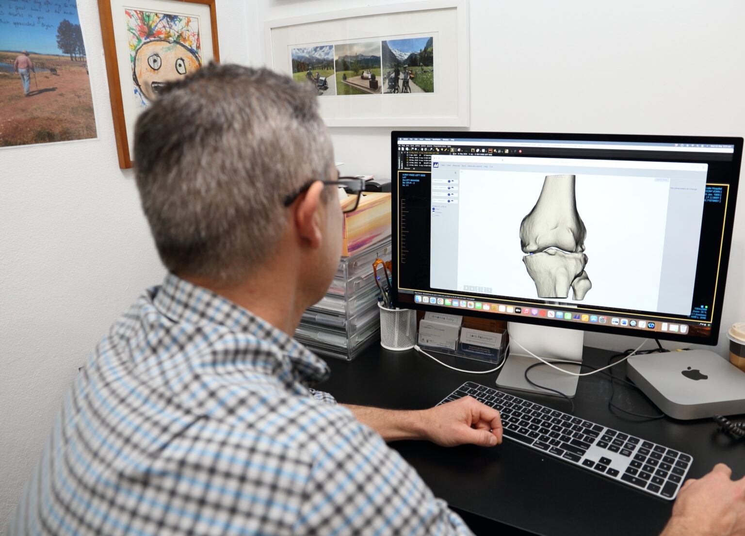 Total Knee Replacement Surgery - Sam Martin
